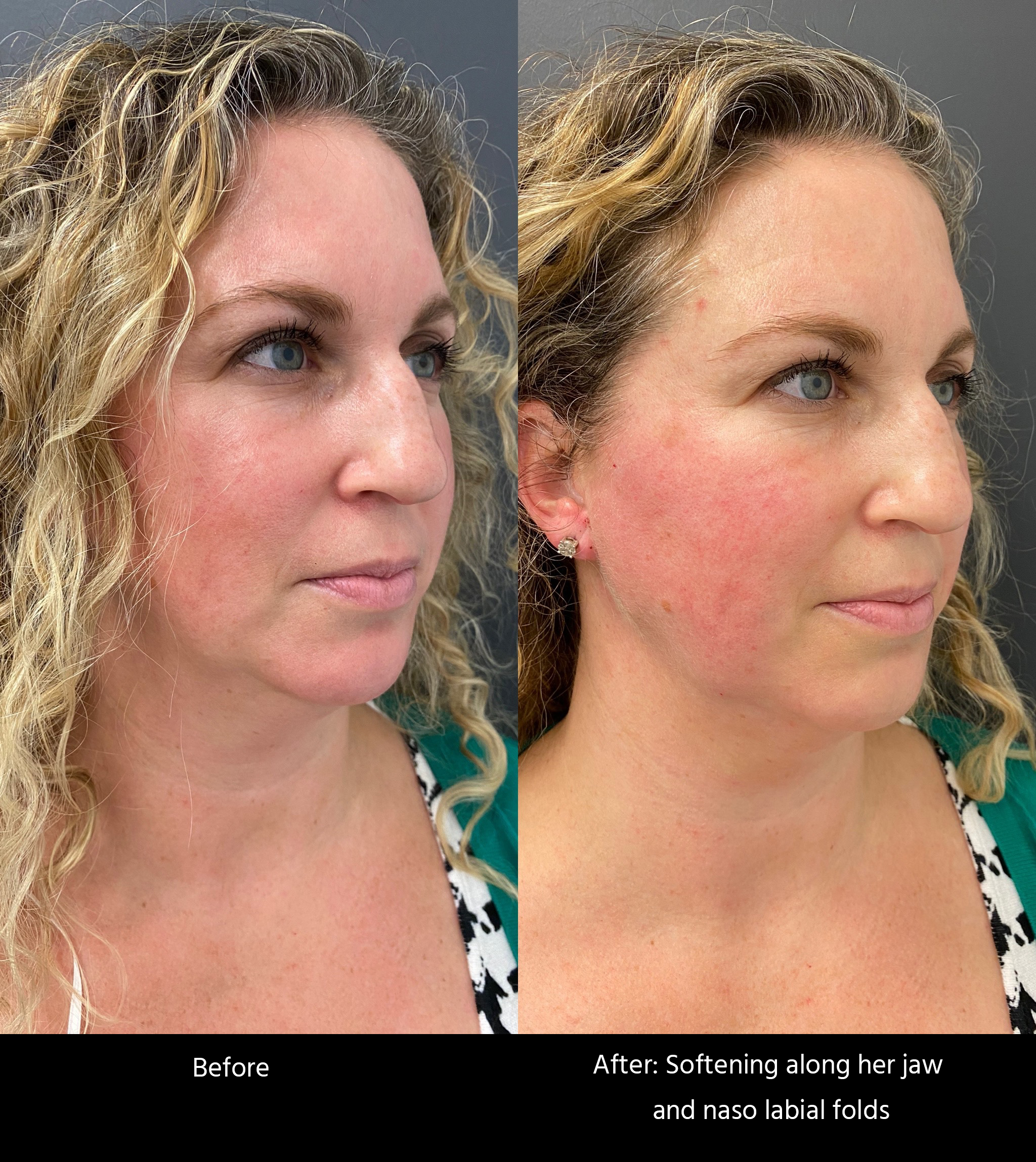 What is a Thread Lift? | The Plastic Surgery Clinic Blog