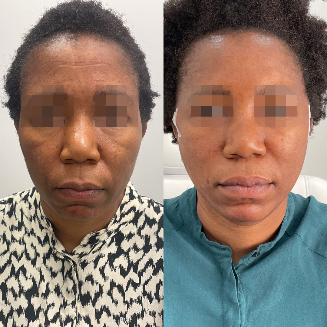 Thread Lift vs. Facelift vs. FaceTite | The Plastic Surgery Clinic Blog