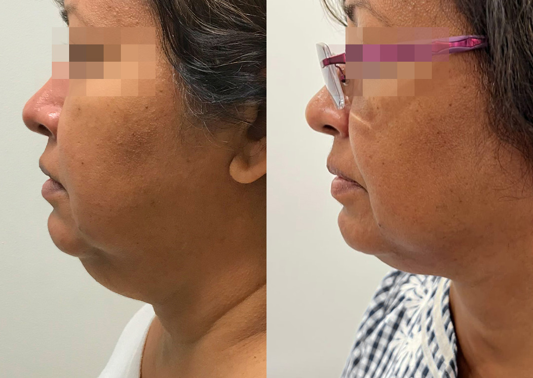 Thread Lift vs. Facelift vs. FaceTite | The Plastic Surgery Clinic Blog